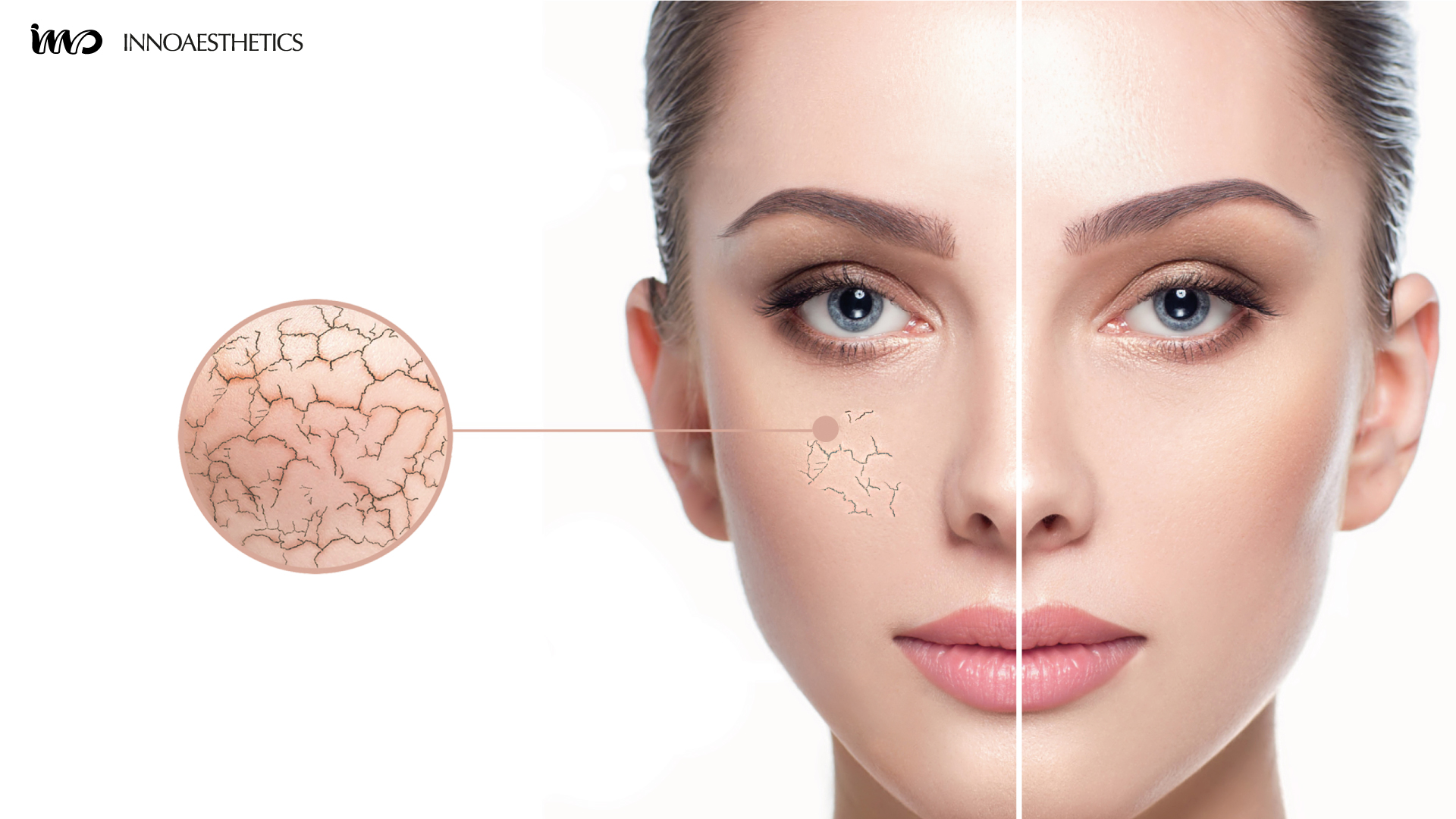 Treatment of Xerosis or Dry Skin - INNOAESTHETICS
