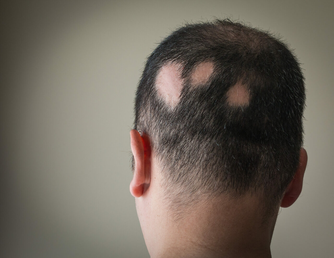 WHAT ARE THE MOST COMMON TYPES OF ALOPECIA AND HOW TO IDENTIFY THEM ...